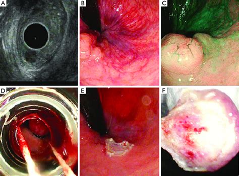 Endoscopic Findings A Eus Image Showing A Hypoechoic Nodule Arising