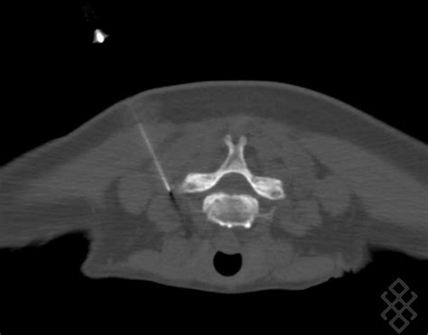 Infiltration Cervicale sous Scanner - Définition & Déroulement - Prise de rdv en ligne