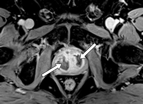 Prostatic Artery Embolization Indications Preparation Techniques Imaging Evaluation