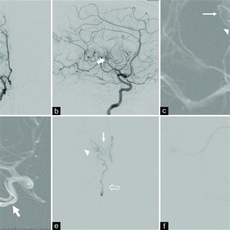 A And B Right Internal Carotid Artery Angiography In Frontal And