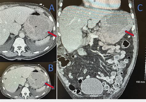 Ct Showing Thickened Gastric Mucosa Red Arrows A And B Axial Images