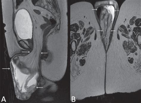 Pelvic Floor Prolapse Sagittal A And Dynamic Axial B Mri