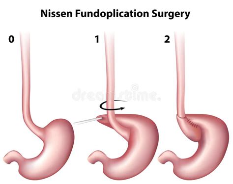 Nissen Fundoplication Surgery Stock Vector Illustration Of Human