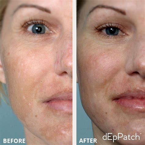 Microcurrent Skincare Before And After Results Good Skin Bright Skin Even Skin Tone