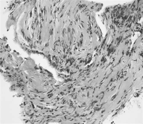 Preoperative Endoscopic And Biopsy Findings A B Protruding Mass 4×4