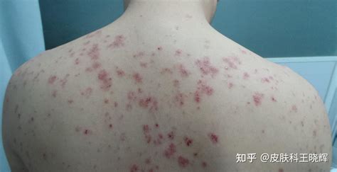 银屑病的病名来历牛皮癣 知乎