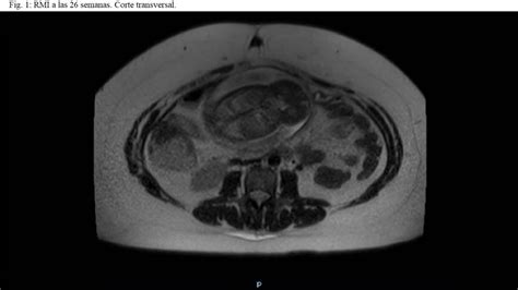 Embarazo Ectópico Abdominal Con Feto Viable