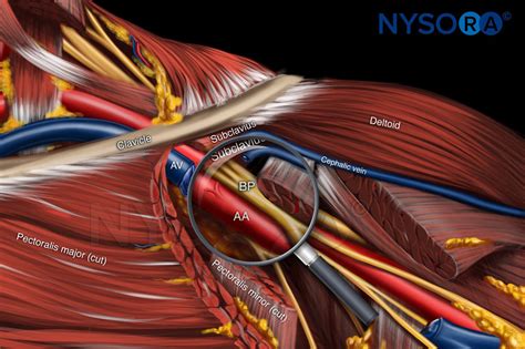 Nysora Infraclavicular Nerve Block
