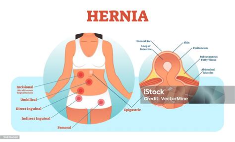 탈 장 유형 벡터 일러스트 레이 션 및 근육 파열 및 내장의 횡단면 탈장에 대한 스톡 벡터 아트 및 기타 이미지 탈장 복부 복부 근육 Istock