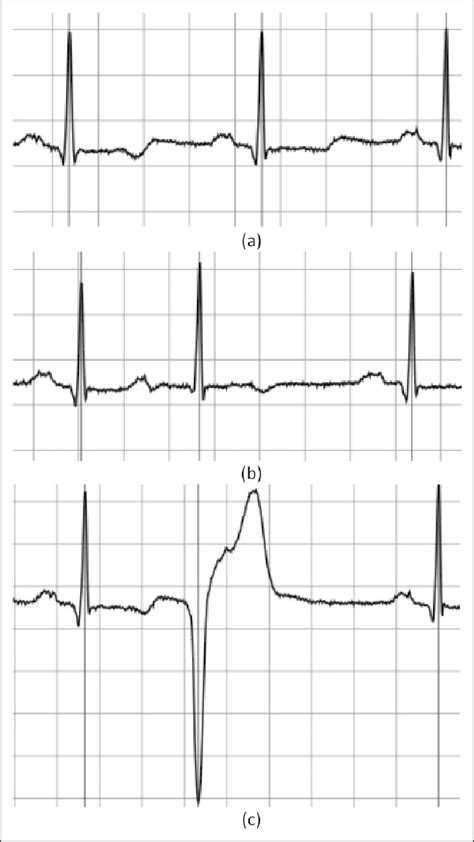 Erratic Heartbeat