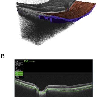 Partial Dimensional Image Of A Mm Scan Obtained With DRI OCT Download Scientific