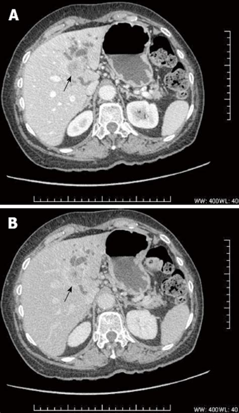 Radiological Diagnosis And Staging Of Hilar Cholangiocarcinoma