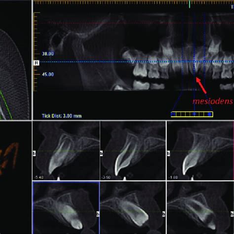 Cbct Images Demonstration Delayed Eruption And Ectopic Eruption Path Of Download Scientific