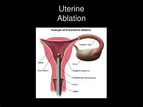 Ppt Female And Male Reproductive System And Hsg And Prostate Imaging
