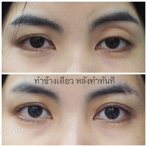 ทำตาสองชั้นข้างเดียว แบบนี้ก็ได้หรอ Inz Clinic