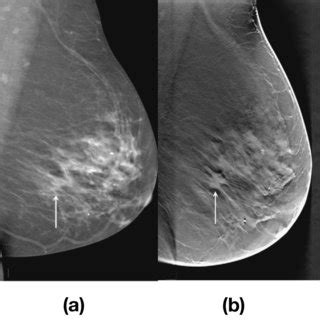 Examples Of The Variety Of Shapes Of Micro Calcification Clusters Download Scientific
