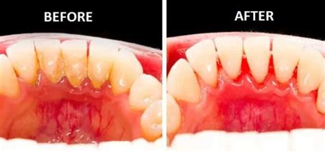 Calculus Bridge Everything You Should Know About It Planmymedical