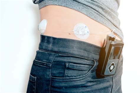 Best Practices Around Using An Insulin Pump And Sensor Edgepark