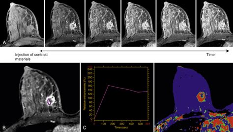 Magnetic Resonance Imaging Of Breast Cancer And Magnetic Resonance
