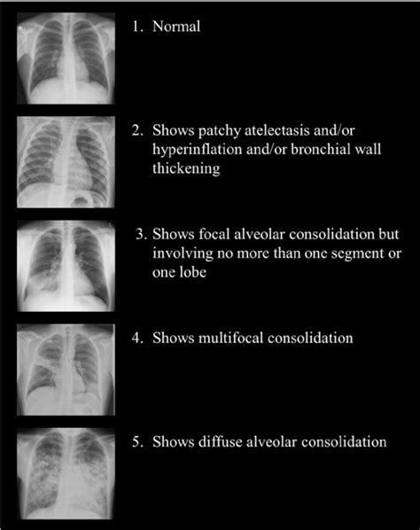 The Chest Radiograph Severity Scoring System Download Scientific Diagram