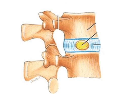 Disco Intervertebral Normal Quiz