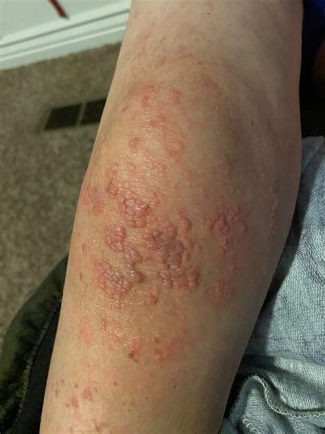 Papillomatosis Of Skin