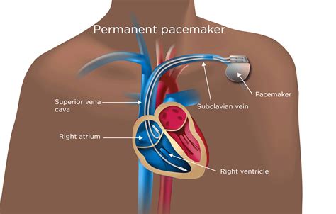 Heart Block My Doctor Online