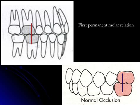 Classification Of Normal Occlusion And Malocclusion