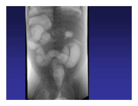 Recurrent Intussusception