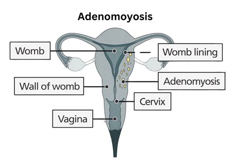 What Is Adenomyosis — The Adeno Gang