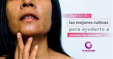 Aquí te doy las mejores rutinas para ayudarte a eliminar las manchas Dr Oscar Gaona Medicina