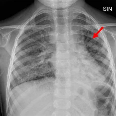 Chest X Ray Retrocardiac Pulmonary Consolidation In The Left Lower