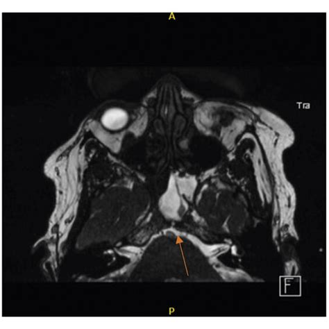 Mri Skull Base With Iv Contrast Axial Cut Showing Fluid Accumulation In Download Scientific