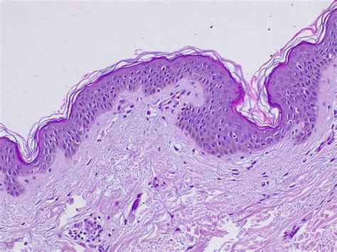 Hyperkeratosis Histology