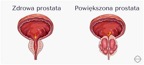 Czym jest prostata i jak zapobiegać jej przerostowi