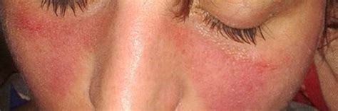 Lupus Eritematoso Sistemico Quali Sono I Sintomi Ilgiornaleit
