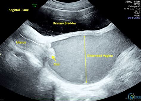 Hematocolpos Secondary To Imperforate Hymen Drkalirajanscans