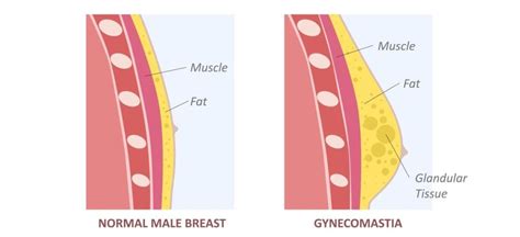 Will Gyno Go Away On Its Own Gynecomastia La 2024