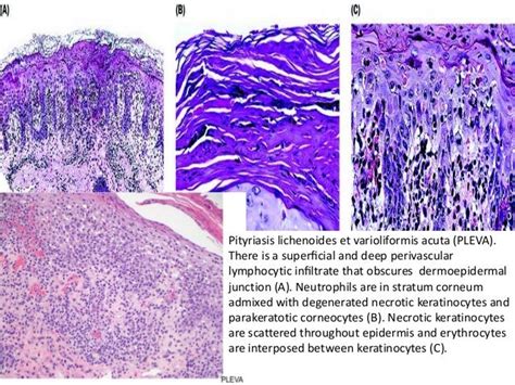 Interface Dermatitis Tutorial