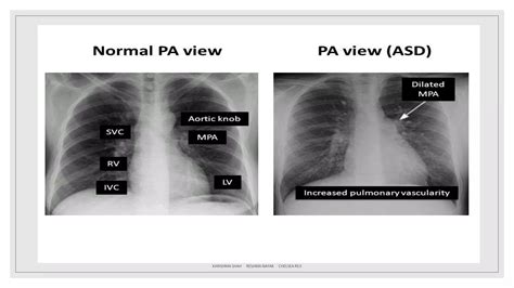 Atrial Septal Defect Asd Ppt