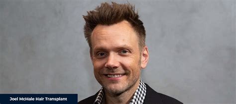Joel Mchale Hair Transplant Smile Hair Clinic