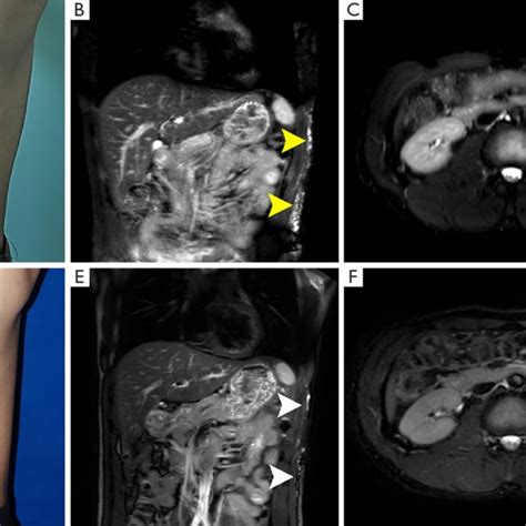 Bleomycin Sclerotherapy For Recurrent Microcystic Lymphatic