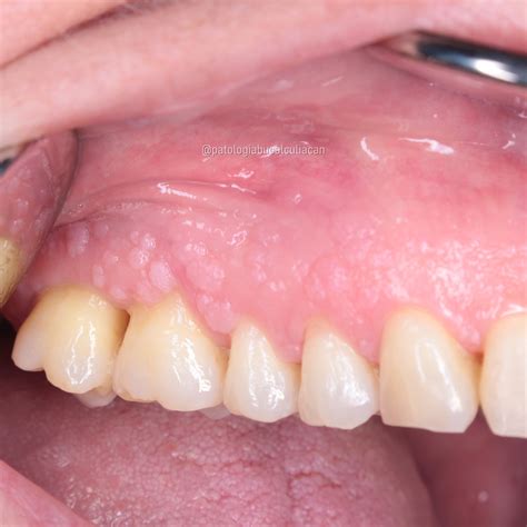 Patología y Medicina Oral | PAPILOMA ESCAMOSO ORAL Los papilomas suelen ser únicos la gran ...