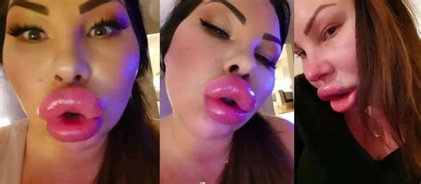 Addicted2implants On Tumblr