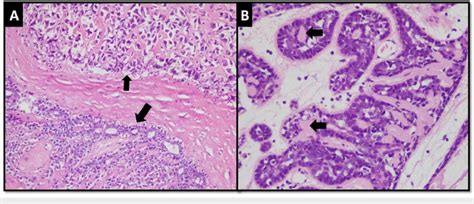 A Transition Between Benign Component Larger Arrow And Sarcomatous Download Scientific