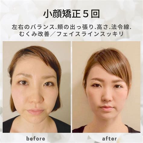 小顔矯正は続けないと元に戻る？ 東京表参道青山渋谷【bitoria】本格小顔骨盤美容矯正サロン