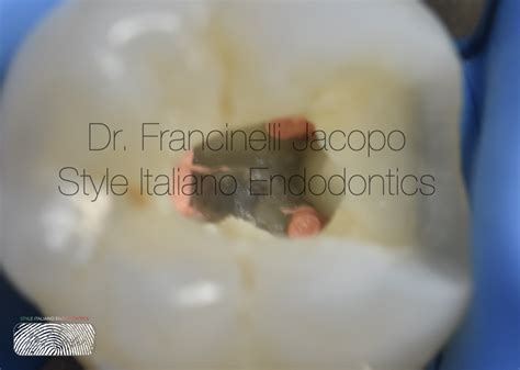 Lower Molar With Narrow Mesial Canals Style Italiano Endodontics