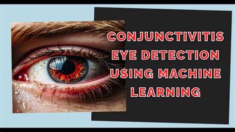 Conjunctivitis Eye Detection Using Machine Learning Youtube