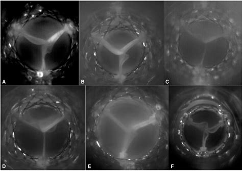 Figure 1 From The Hemodynamics Of Transcatheter Aortic Valves In