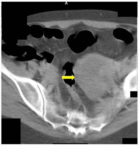 High Concordance Of Ct Colonography And Colonoscopy Allows For The